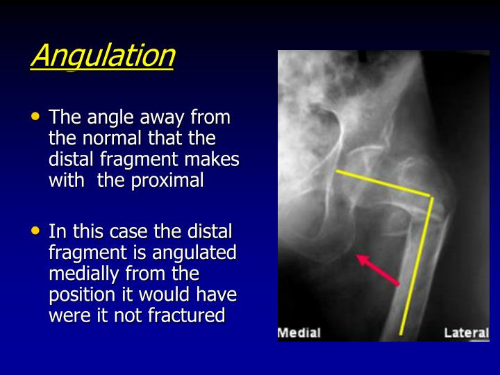 PPT - Recognizing fractures PowerPoint Presentation - ID:3139406