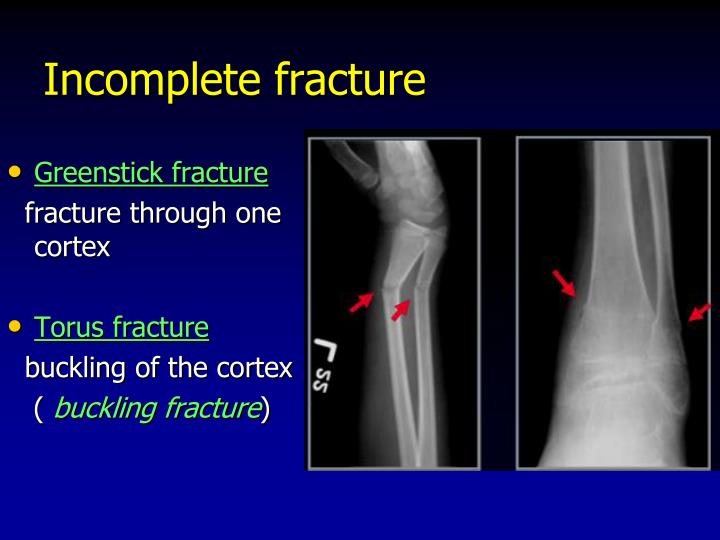 PPT - Recognizing fractures PowerPoint Presentation - ID:3139406