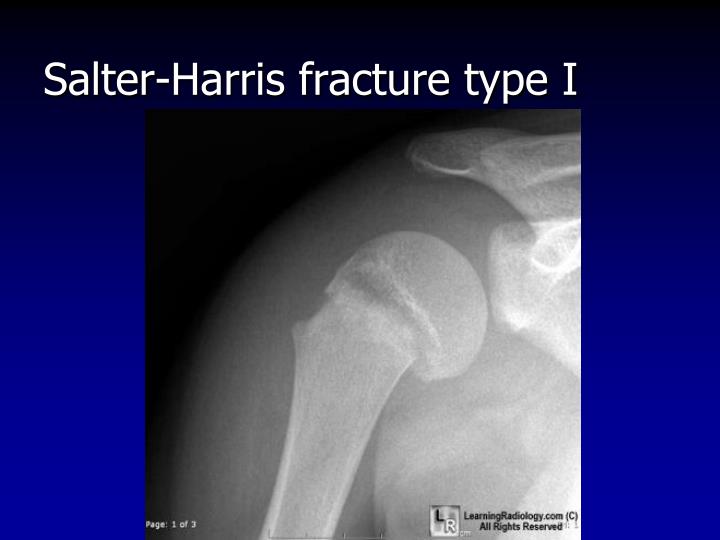 PPT - Recognizing fractures PowerPoint Presentation - ID:3139406
