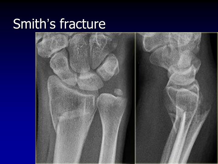 PPT - Recognizing fractures PowerPoint Presentation - ID:3139406