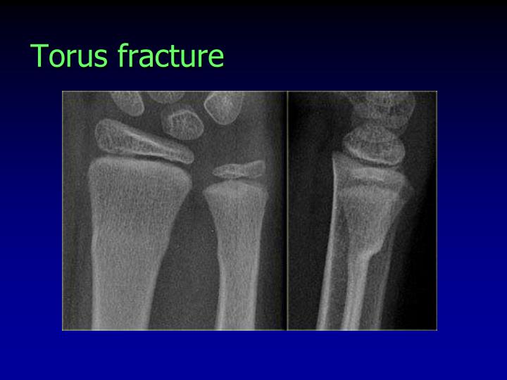 PPT - Recognizing fractures PowerPoint Presentation - ID:3139406
