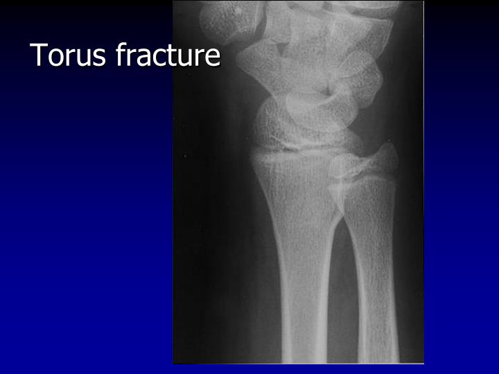 PPT - Recognizing fractures PowerPoint Presentation - ID:3139406