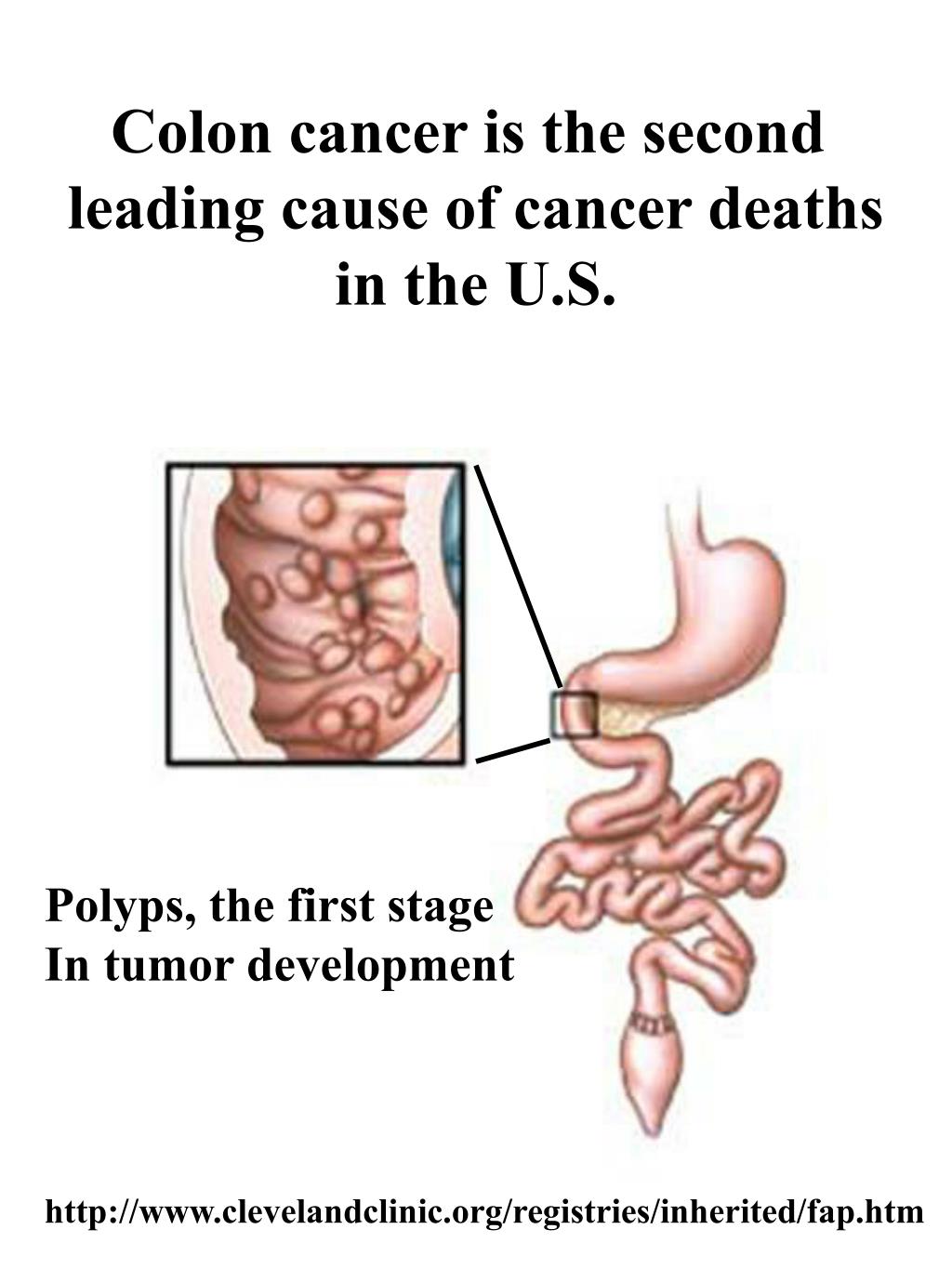 PPT - Colon cancer is the second leading cause of cancer deaths in the ...