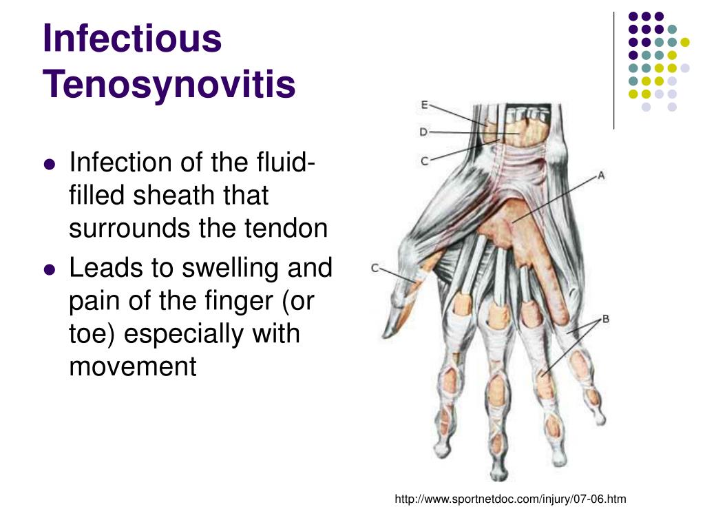 PPT - Soft Tissue & Musculoskeletal Infections in the Primary Care ...
