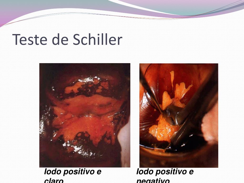 Teste De Schiller Positivo - RETOEDU
