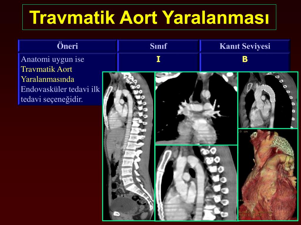 PPT - Torakal Aort Hastalıkları Endovasküler Tedavisinde Güncel Durum ...