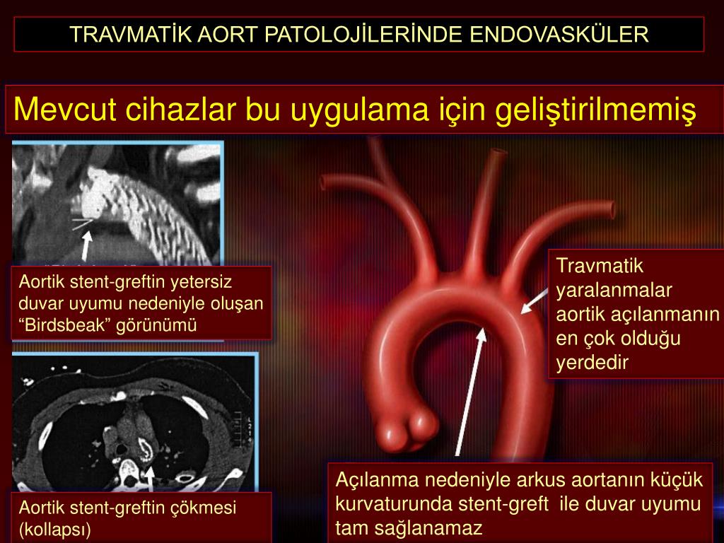 PPT - Torakal Aort Hastalıkları Endovasküler Tedavisinde Güncel Durum ...