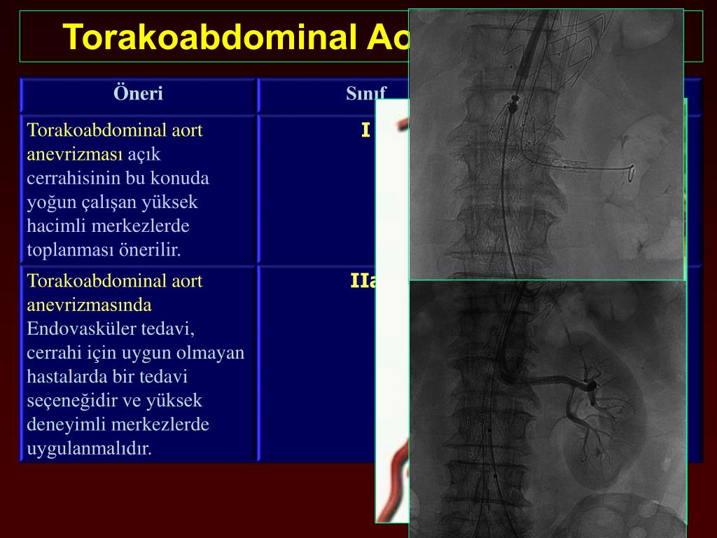 PPT - Torakal Aort Hastalıkları Endovasküler Tedavisinde Güncel Durum ...
