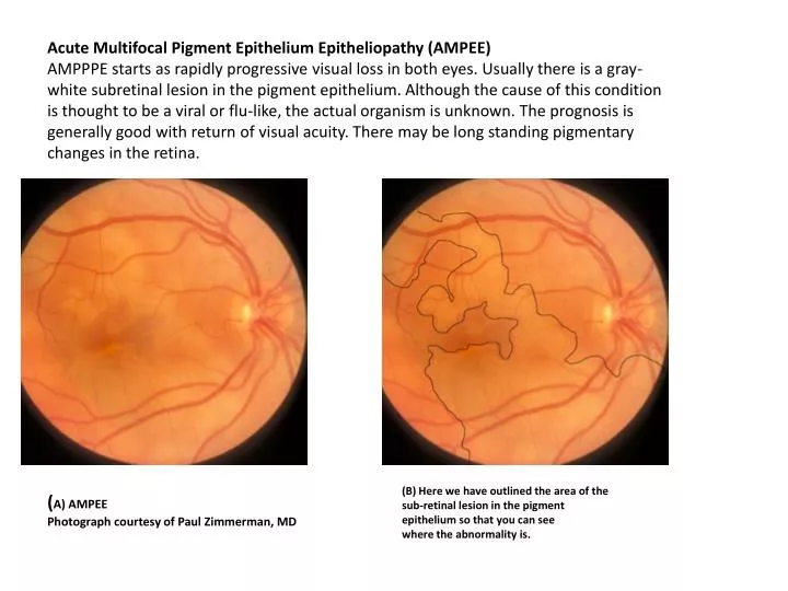 PPT - Acute Multifocal Pigment Epithelium Epitheliopathy (AMPEE ...