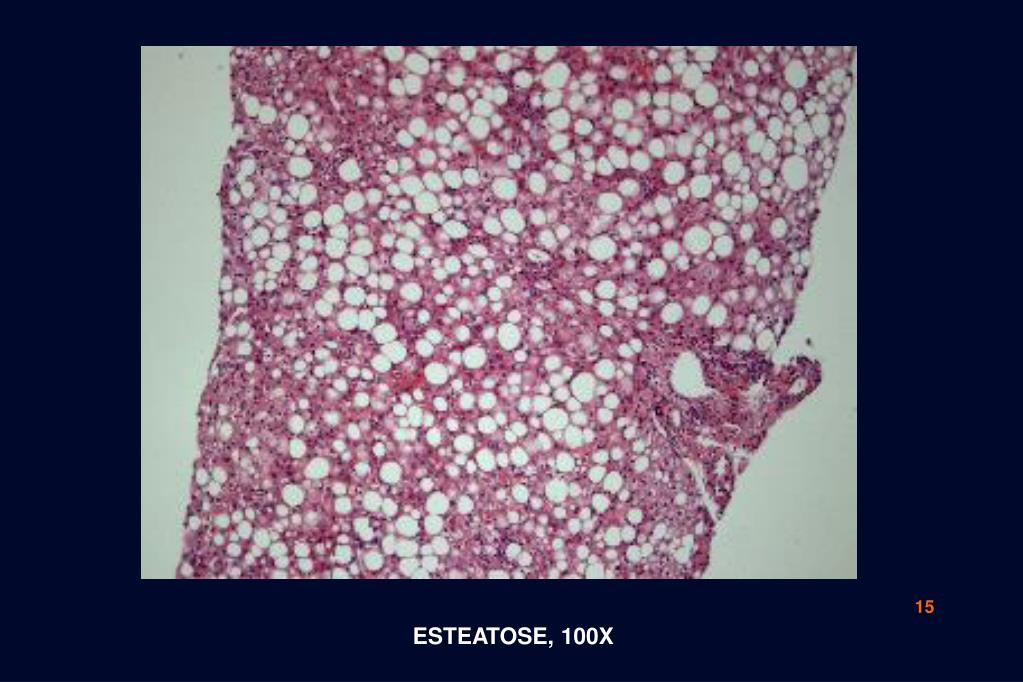PPT - ESTEATOSE HEPÁTICA DE ETIOLOGIA NÃO ALCOÓLICA PowerPoint ...