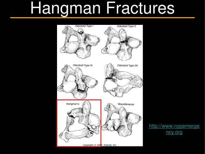 PPT - Surgical Approach: Fixation at C1-2 PowerPoint Presentation - ID ...
