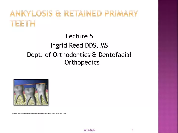 PPT - Ankylosis & Retained Primary Teeth PowerPoint Presentation, free ...