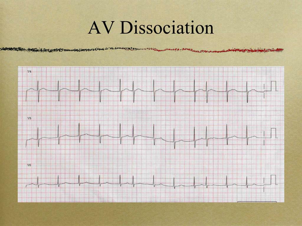 PPT - Wolff-Parkinson-White and Atrioventricular (AV) Heart Blocks ...