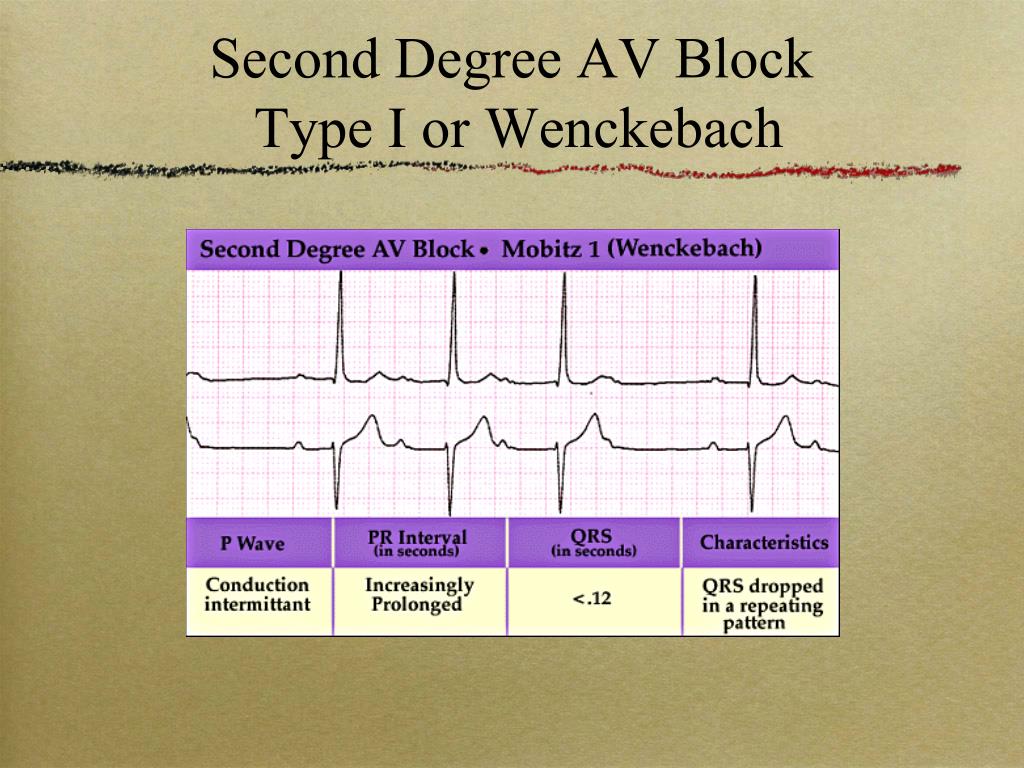 PPT - Wolff-Parkinson-White and Atrioventricular (AV) Heart Blocks ...