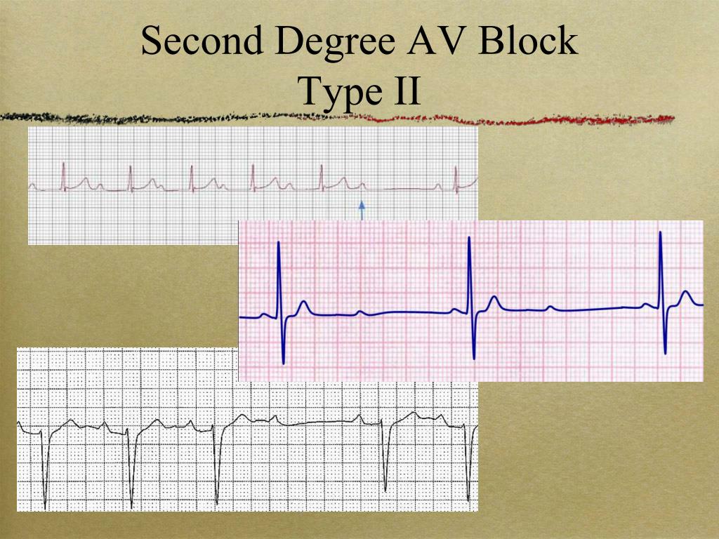 PPT - Wolff-Parkinson-White and Atrioventricular (AV) Heart Blocks ...