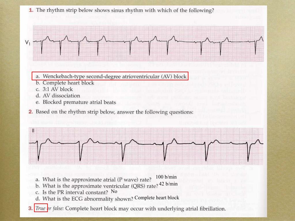 PPT - Wolff-Parkinson-White and Atrioventricular (AV) Heart Blocks ...
