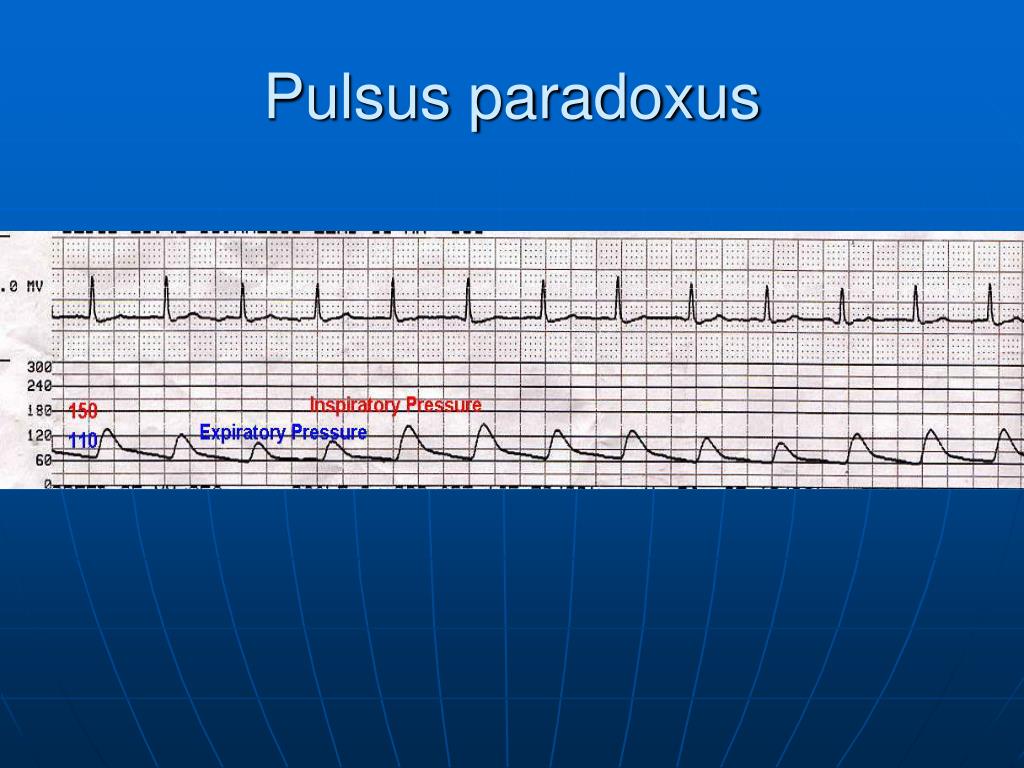 PPT - Invasive blood pressure monitoring in critical care PowerPoint ...