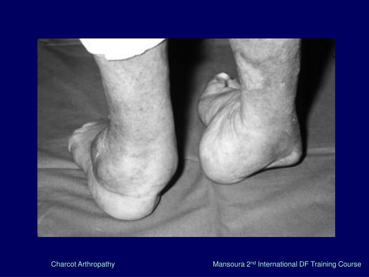 PPT - Charcot Arthropathy . PowerPoint Presentation - ID:3199325