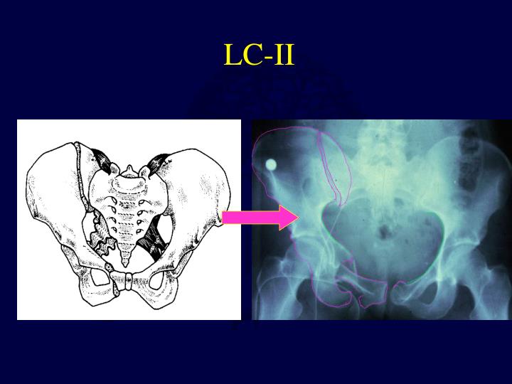 PPT - Anatomy, Radiographic Evaluation, and Classification of Pelvic ...