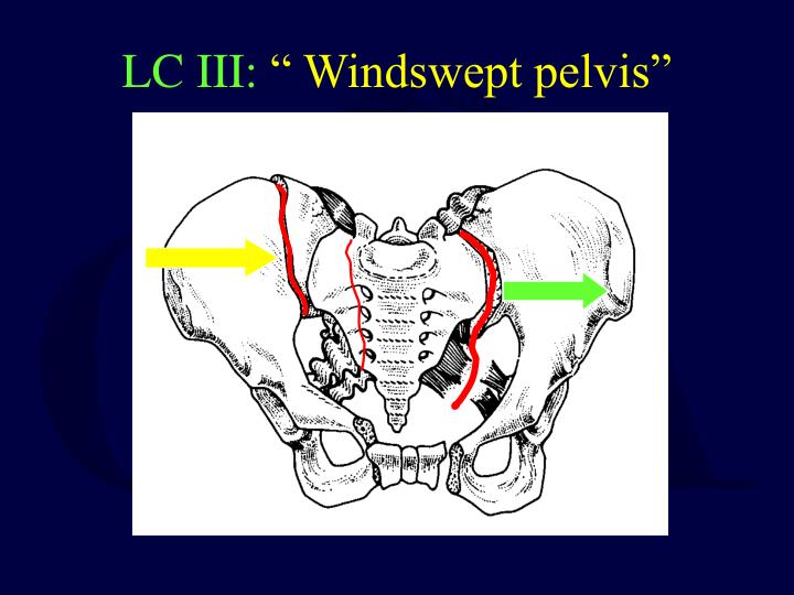 PPT - Anatomy, Radiographic Evaluation, and Classification of Pelvic ...