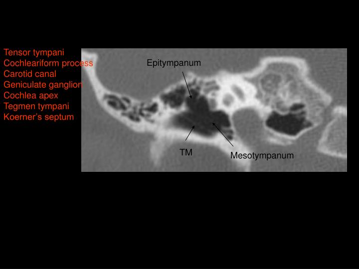 PPT - CT Temporal Bone PowerPoint Presentation - ID:3204041