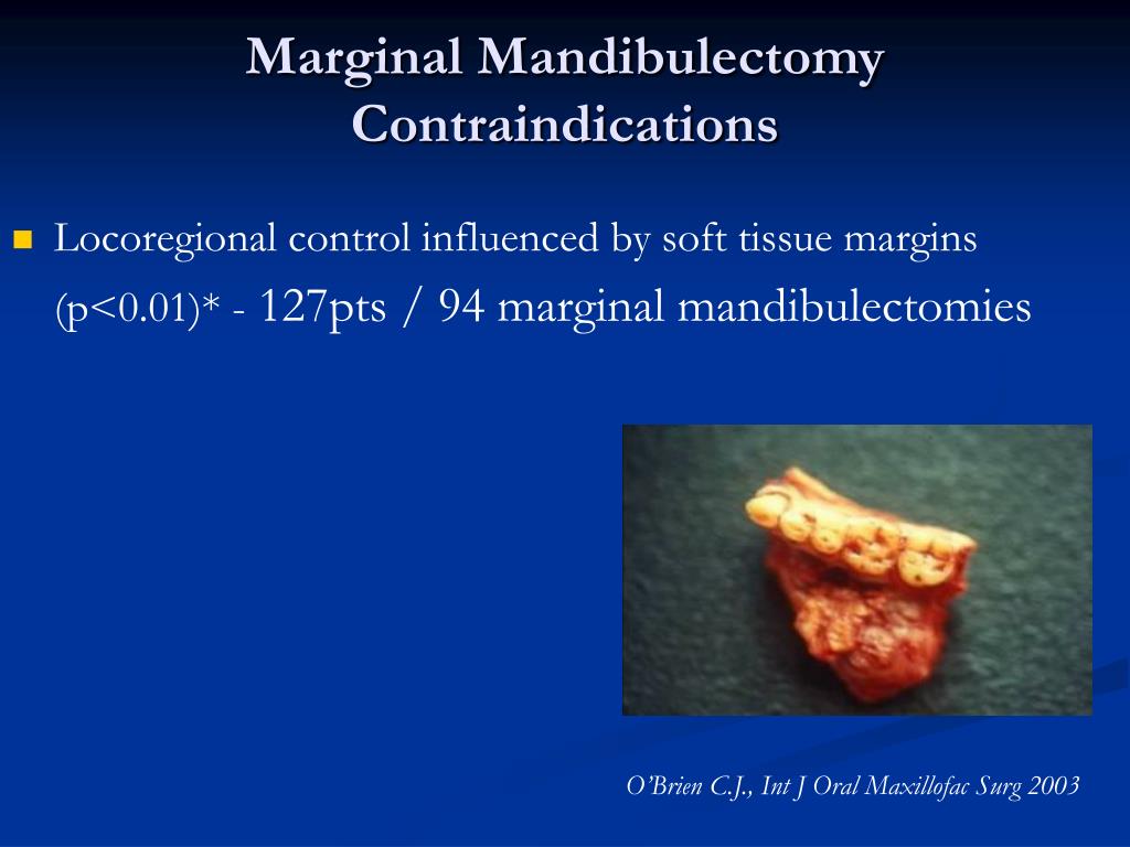 PPT - Evidence Based Management Gingivo-Buccal Cancer PowerPoint ...