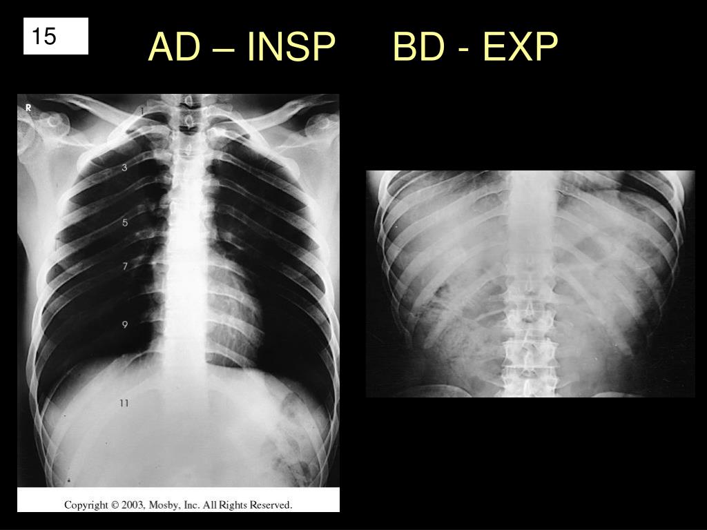 PPT - PA -anterior side BEST SEEN AP -posterior side BEST SEEN ...