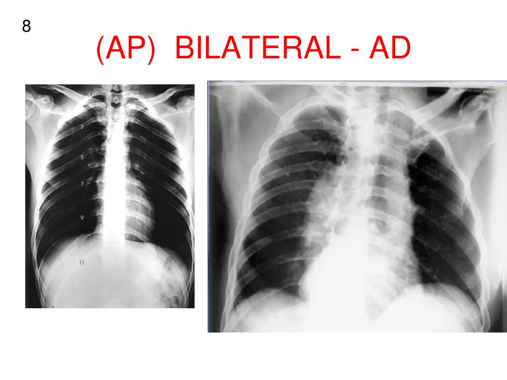 PPT - PA -anterior side BEST SEEN AP -posterior side BEST SEEN ...