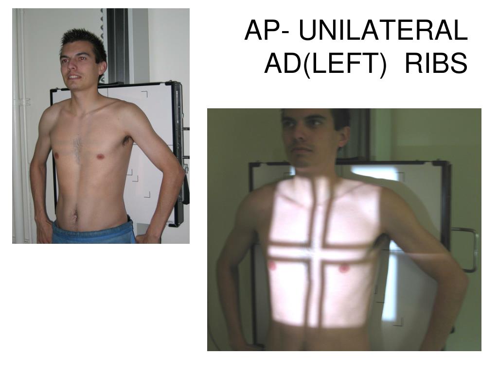 PPT - PA -anterior side BEST SEEN AP -posterior side BEST SEEN ...