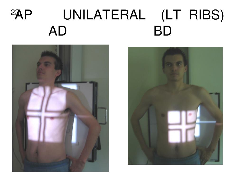PPT - PA -anterior side BEST SEEN AP -posterior side BEST SEEN ...