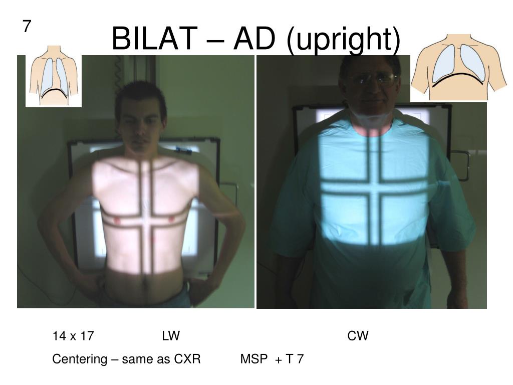 PPT - PA -anterior side BEST SEEN AP -posterior side BEST SEEN ...