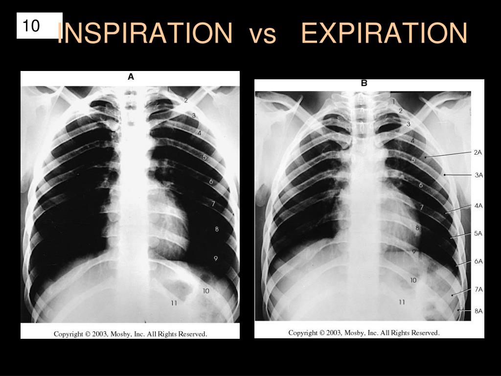 PPT - PA -anterior side BEST SEEN AP -posterior side BEST SEEN ...