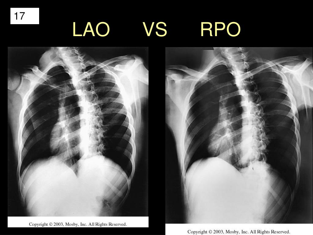 PPT - PA -anterior side BEST SEEN AP -posterior side BEST SEEN ...