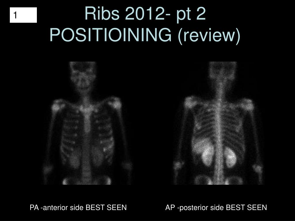 PPT - PA -anterior side BEST SEEN AP -posterior side BEST SEEN ...