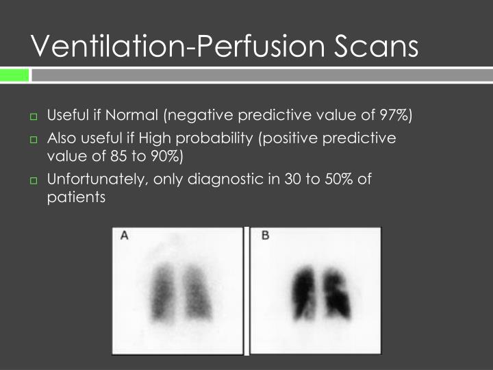 PPT - Pulmonary Embolism Presentation to Diagnosis PowerPoint ...