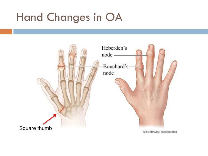 PPT - Rheumatoid Arthritis Vs Osteoarthritis PowerPoint Presentation ...