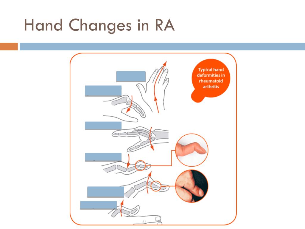 PPT - Rheumatoid Arthritis Vs Osteoarthritis PowerPoint Presentation ...
