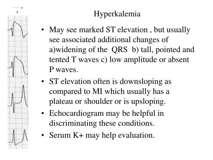 PPT - Differential Diagnosis of ST Segment Elevation PowerPoint ...