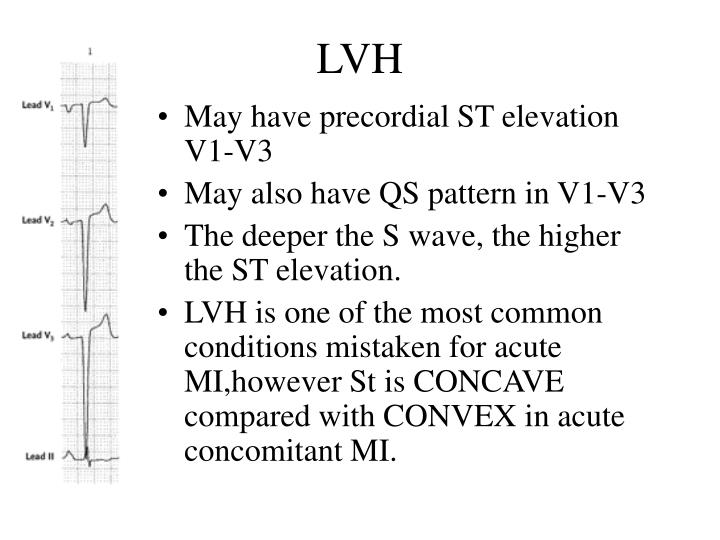 PPT - Differential Diagnosis of ST Segment Elevation PowerPoint ...