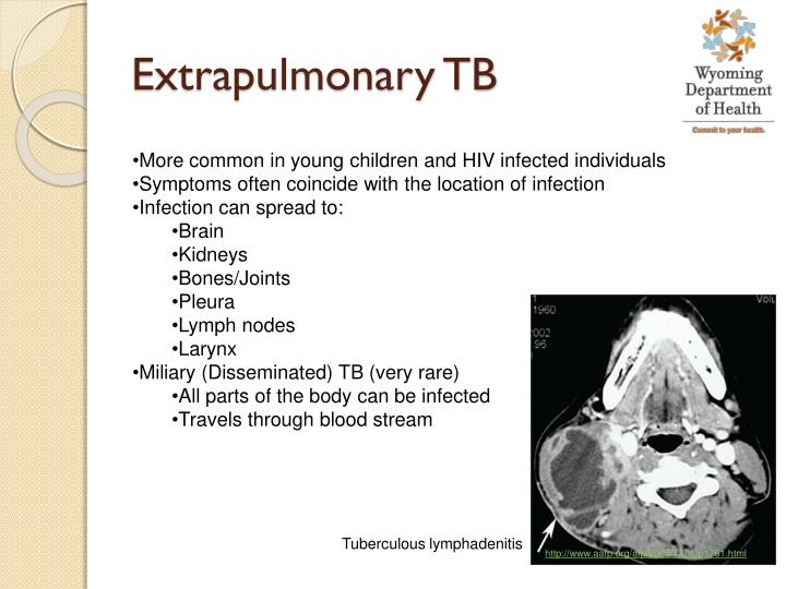 PPT - Tuberculosis PowerPoint Presentation - ID:3212343