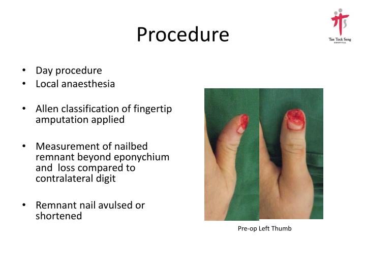 PPT - Modified VY-plasty for Traumatic Distal Nailbed Loss PowerPoint ...