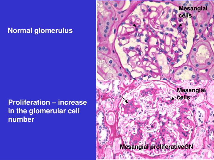 PPT - GLOMERULAR DISEASES PowerPoint Presentation - ID:3216704