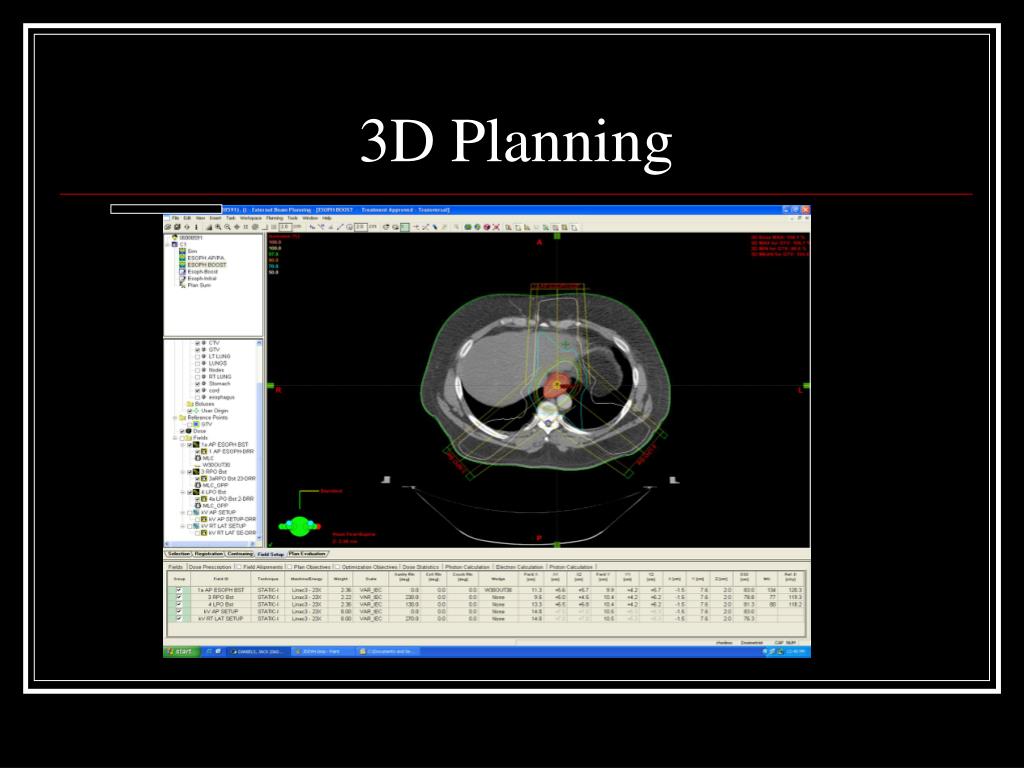 PPT - Radiotherapy Planning for Esophageal Cancers PowerPoint ...