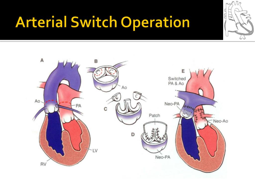 PPT - Cardiac Surgical Anomalies in the Neonate PowerPoint Presentation ...