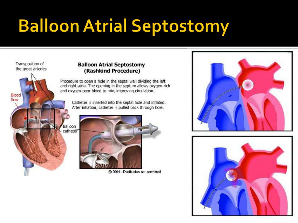 PPT - Cardiac Surgical Anomalies in the Neonate PowerPoint Presentation ...