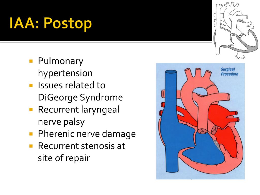 PPT - Cardiac Surgical Anomalies in the Neonate PowerPoint Presentation ...