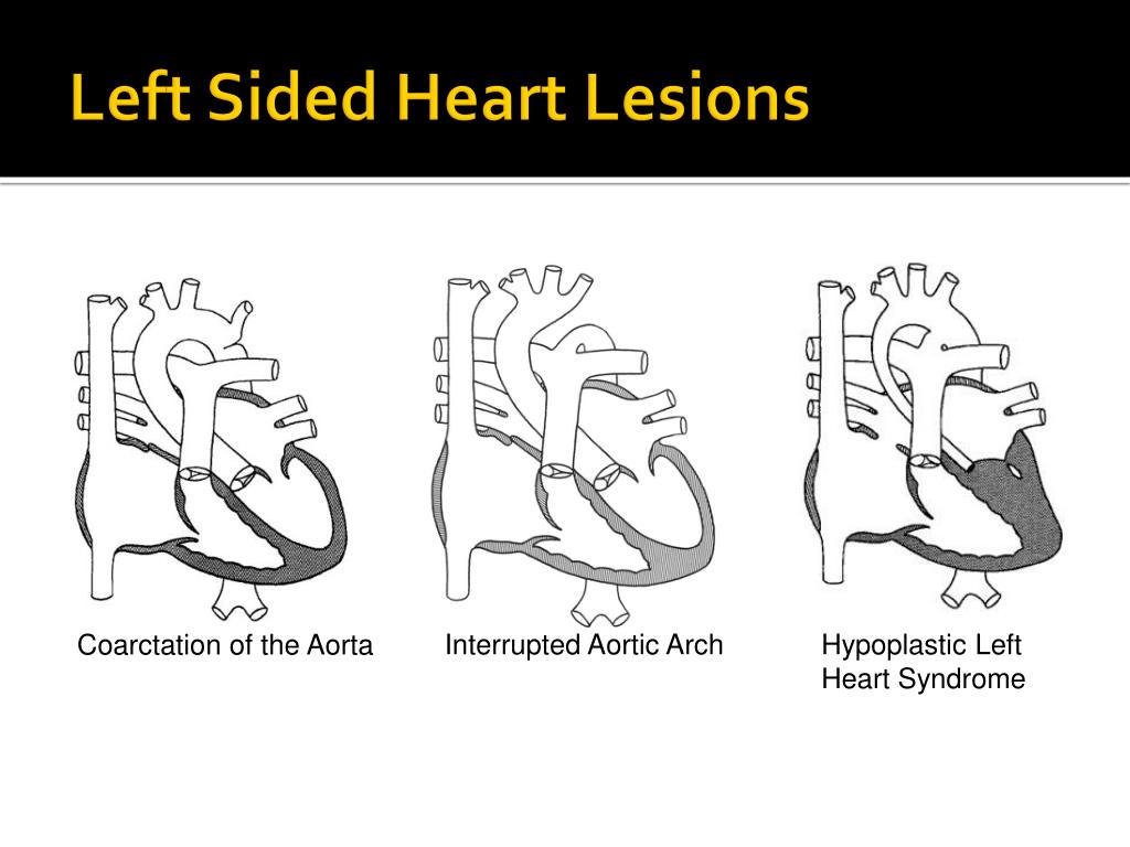 PPT - Cardiac Surgical Anomalies in the Neonate PowerPoint Presentation ...