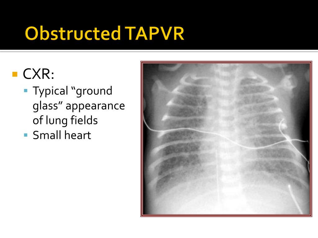 PPT - Cardiac Surgical Anomalies in the Neonate PowerPoint Presentation ...