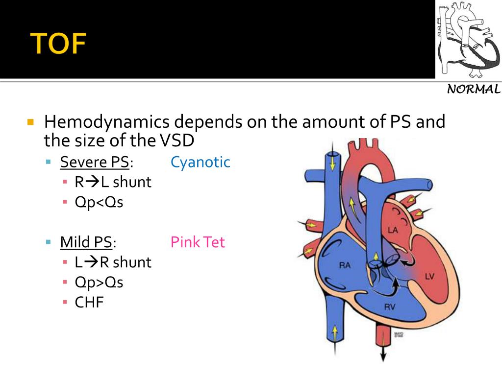 PPT - Cardiac Surgical Anomalies in the Neonate PowerPoint Presentation ...