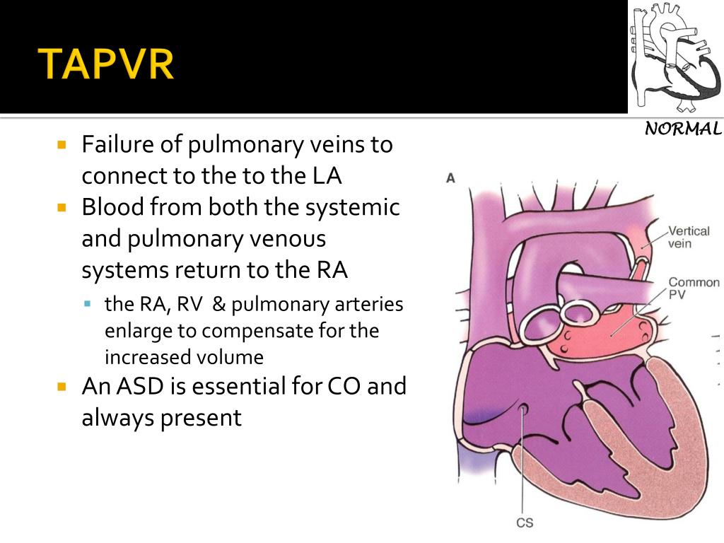 PPT - Cardiac Surgical Anomalies in the Neonate PowerPoint Presentation ...